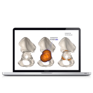 Custom Orthopaedic Implants - Adler Ortho